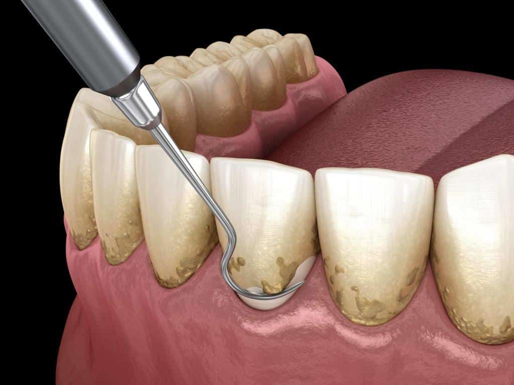What Is Scaling And Root Planing Wilkinson Dental