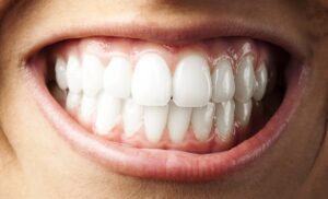 How Is Your Bite Supposed to Look? - Wilkinson Dental
