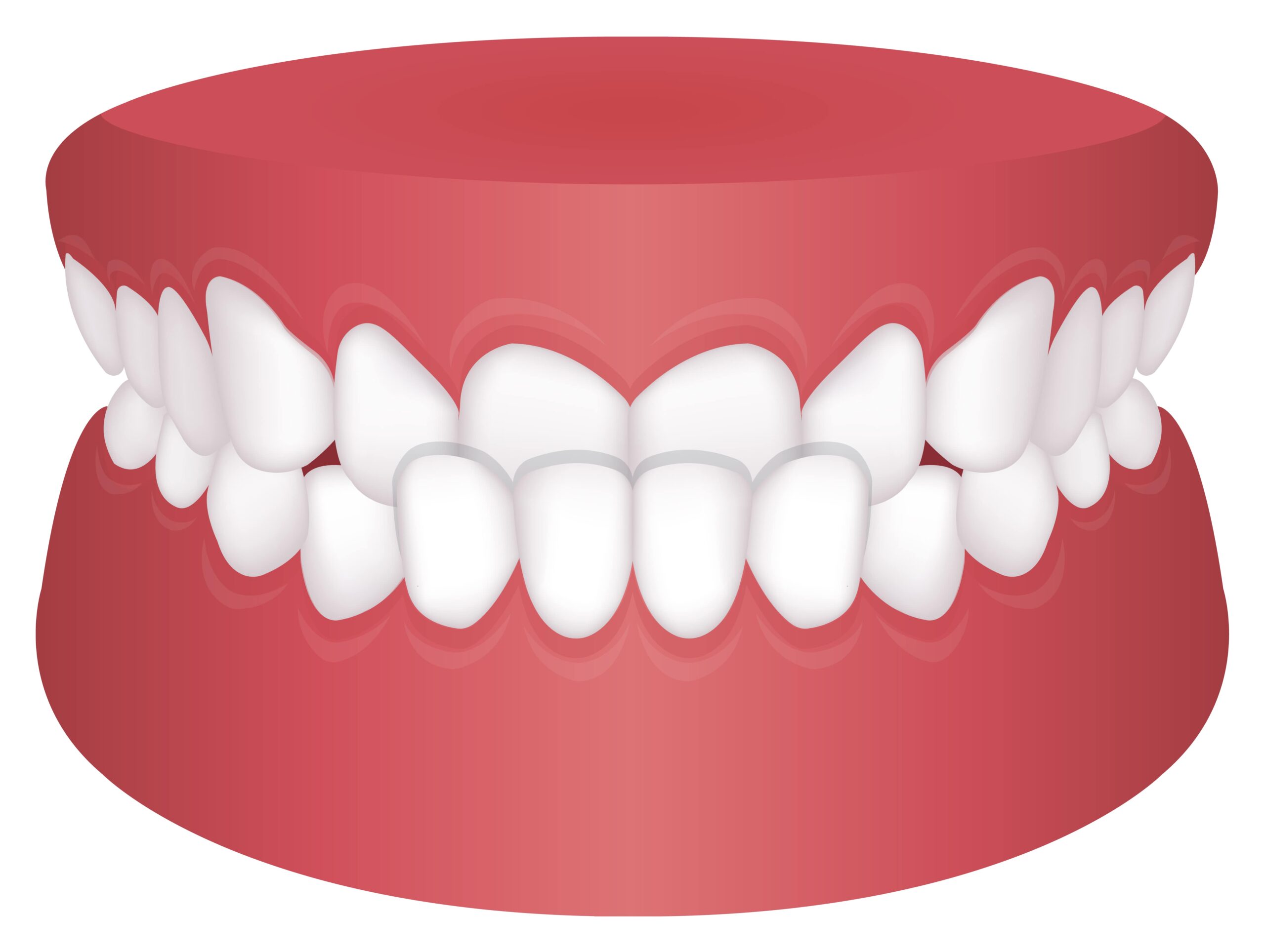 How to Fix an Underbite - Wilkinson Dental